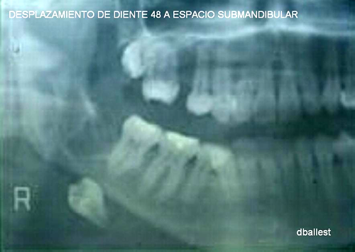 Exodoncia : COMPLICACIONES QUE SE PUEDEN PRESENTAR AL REALIZAR UNA ...