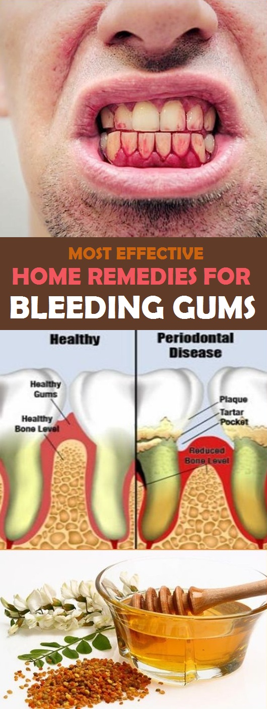 LIFE AT FIT : Most Effective Home Remedies for Bleeding Gums
