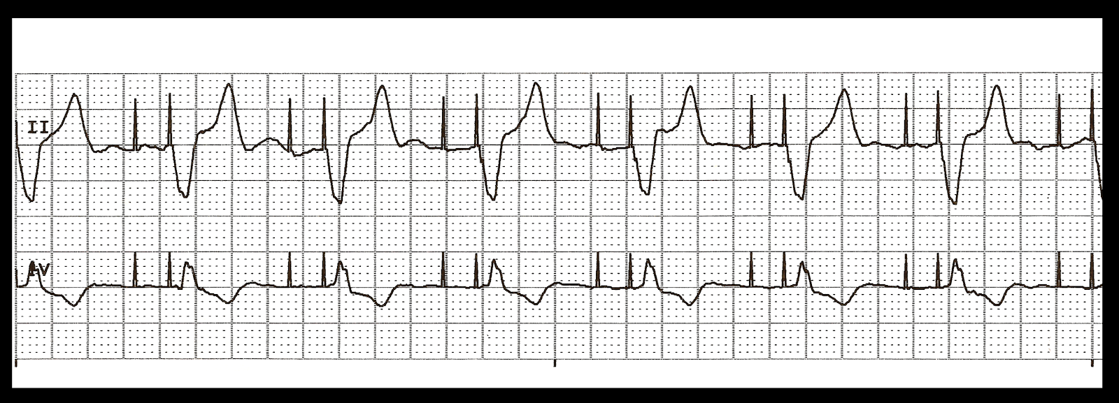 EKG Rhythm Quiz 242