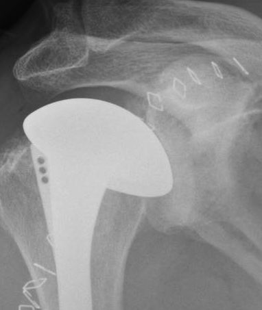 Shoulder Arthritis / Rotator Cuff Tears / Shoulder Pain : Extraordinary ...