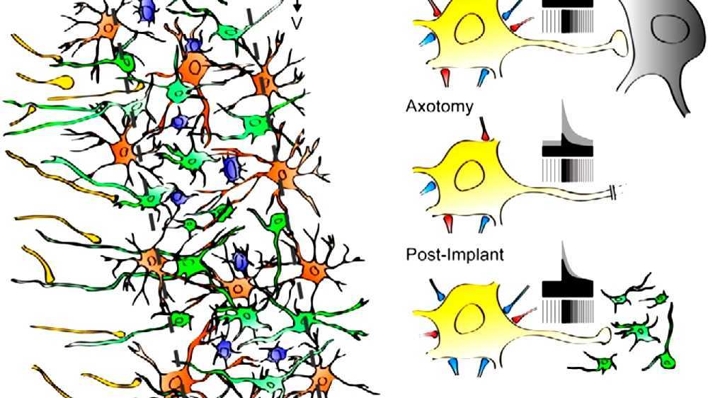 Poly Implant Prothèse