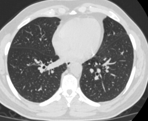Miliary TB-HRCT - Sumer's Radiology Blog