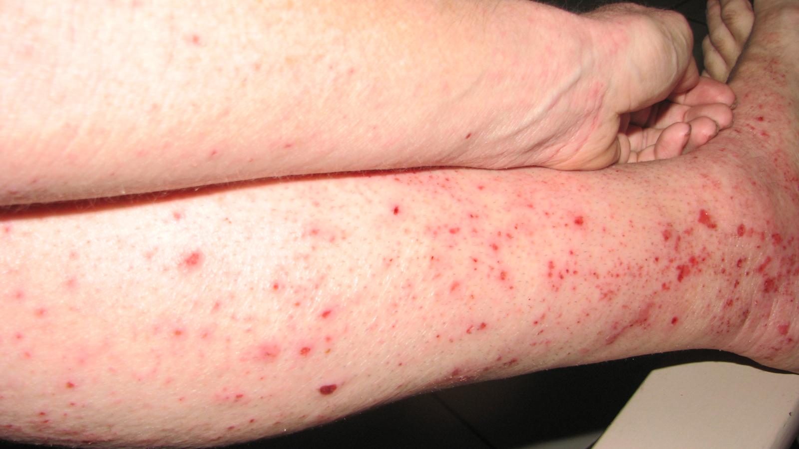 Topical Steroid Withdrawal: April 2012
