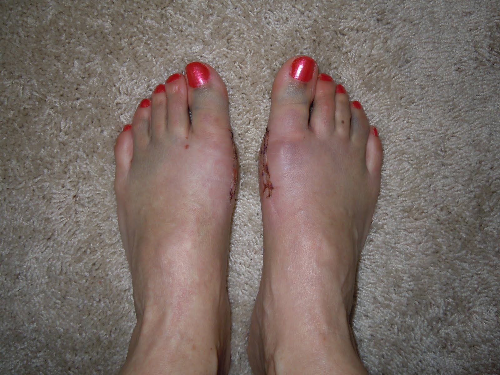 My Two Little Bunions (Chevron Bunionectomy): Day 14 - Post Surgery