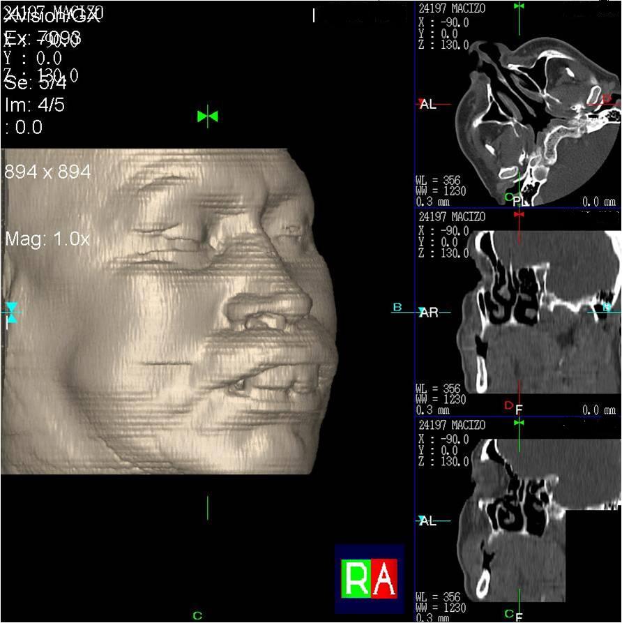 Cirugía de Cabeza y Cuello Rosario: MELANOMA EN PALADAR
