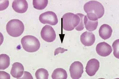 HEMATOLOGIA: ESQUISTOCITO