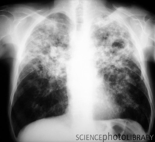 msundalian.blogspot.com: Tuberkulosis (TBC)