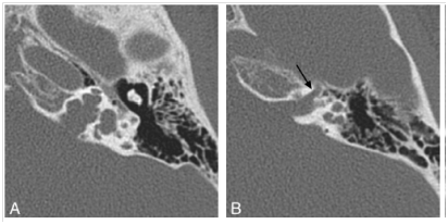 Yakın Doğu Üniv. - Tıp Fakültesi - KBB Anabilim Dalı: ÇOCUKLUK ÇAĞI ...