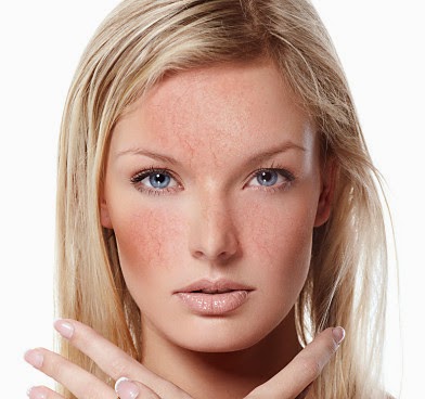 De Tout et de Rien: Comment atténuer la couperose (rosacée)