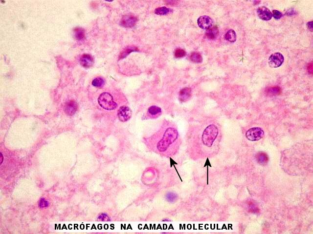 Fichero de Hematologia: Macrofago o Histiocito