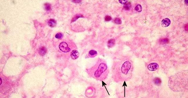 Hematología Fichas: Macrofagos o histiocitos