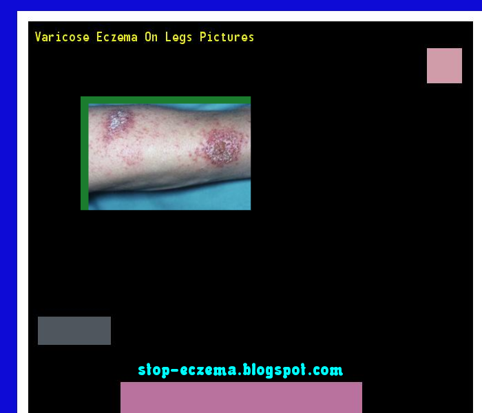 Varicose eczema - Stop Eczema