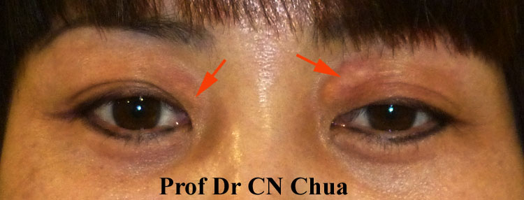 Eyelid Surgery by Prof Dr CN CHUA 蔡鐘能: Unequal Double Eyelids (skin ...