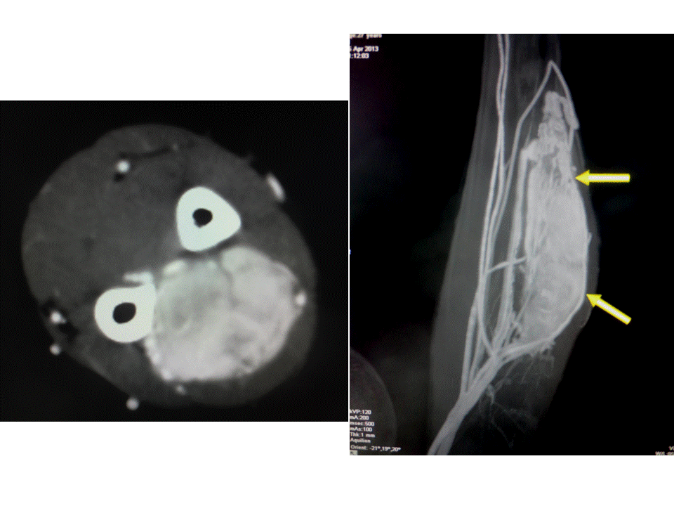 VIETNAMESE MEDIC ULTRASOUND: CASE 183: LEFT ARM MASS, Dr PHAN THANH HẢI ...