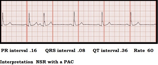 ECG Rhythm Strip Quiz 81: Interval measurements