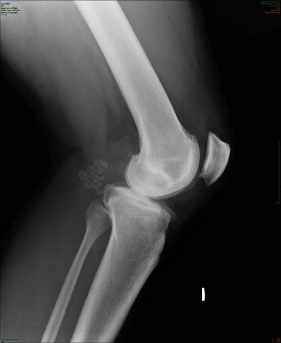 Tu Espacio Radiológico: Proyecciones Básicas de Rodilla