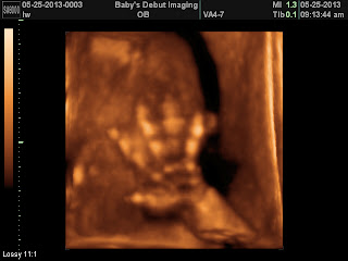 Through the Eyes of Linz: 3D/4D Ultrasound at 28 Weeks