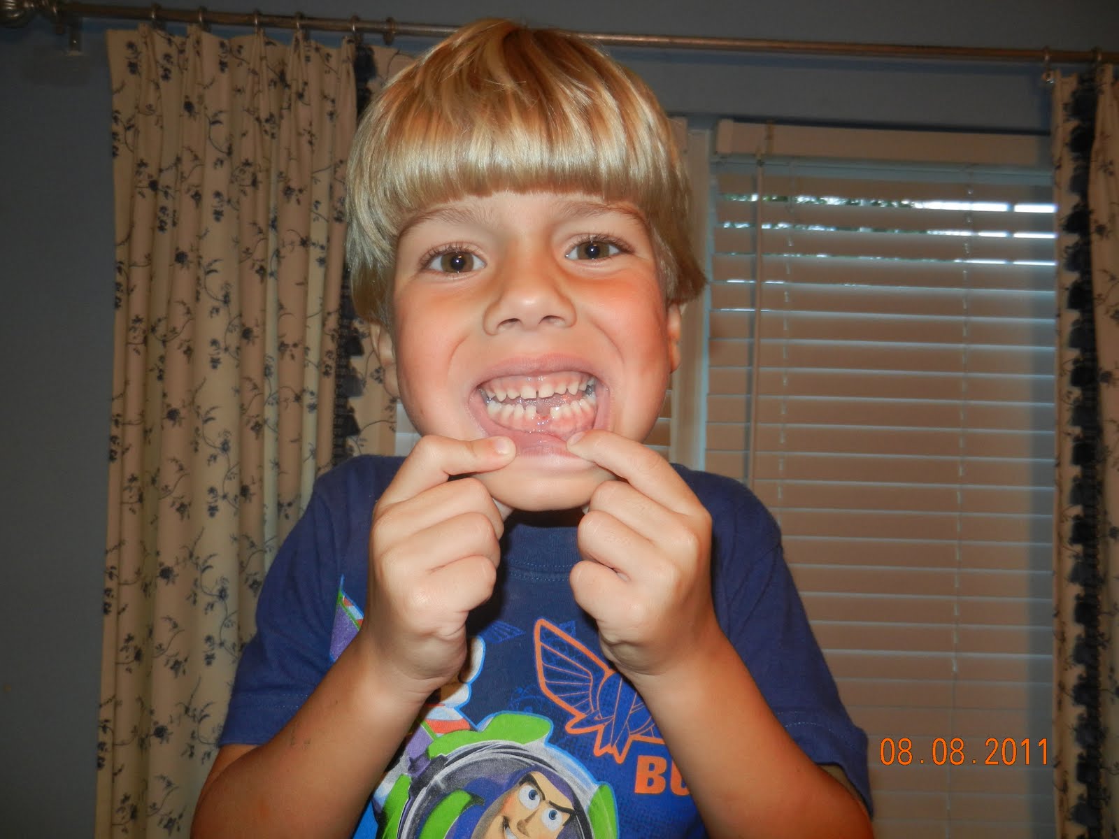 Stover's Story: Loose Tooth Update