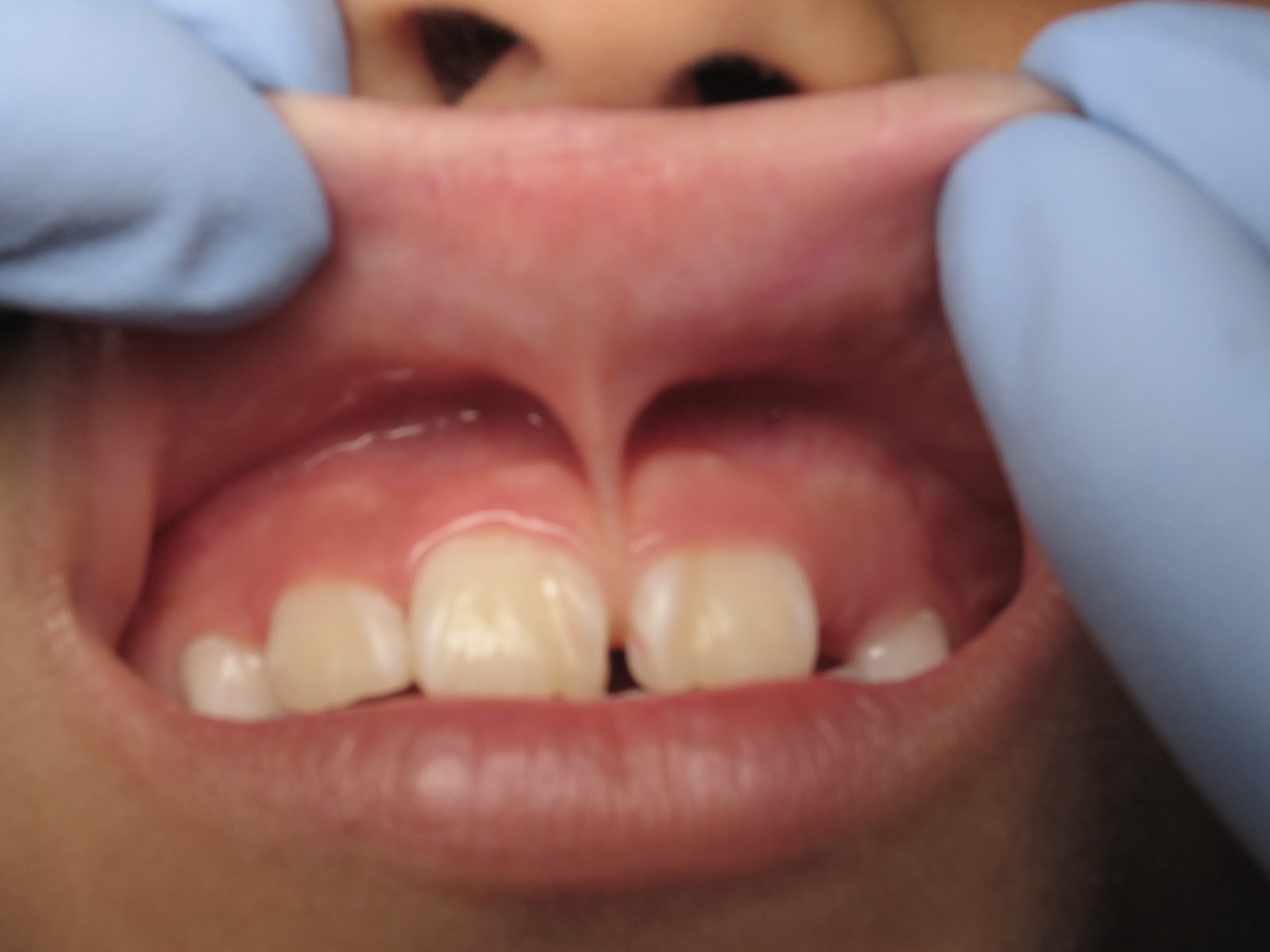 Laser surgery verus scissors for maxillary frenum