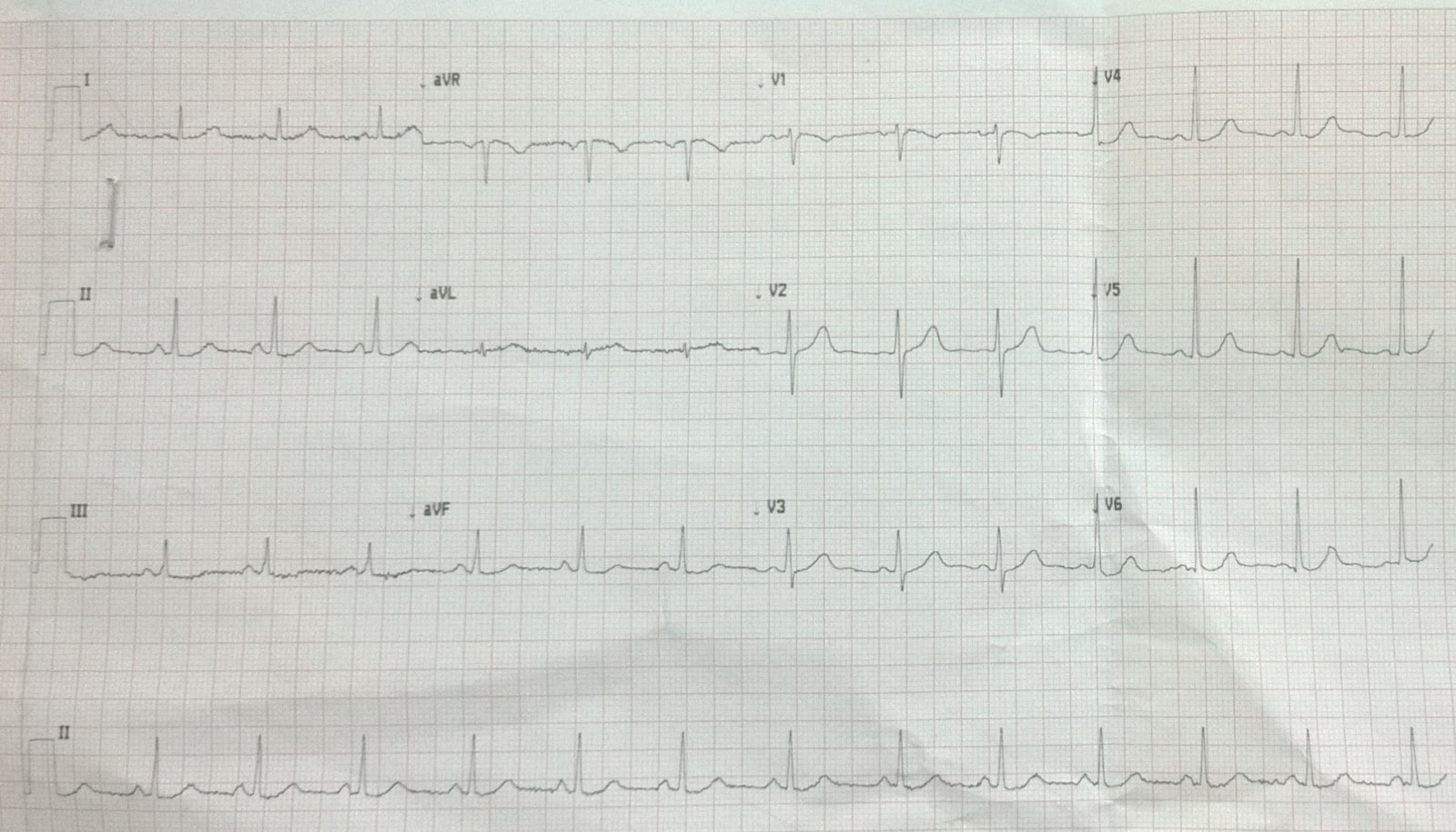 Cardiology window: PSVT