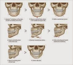 Operasi Rahang Bawah