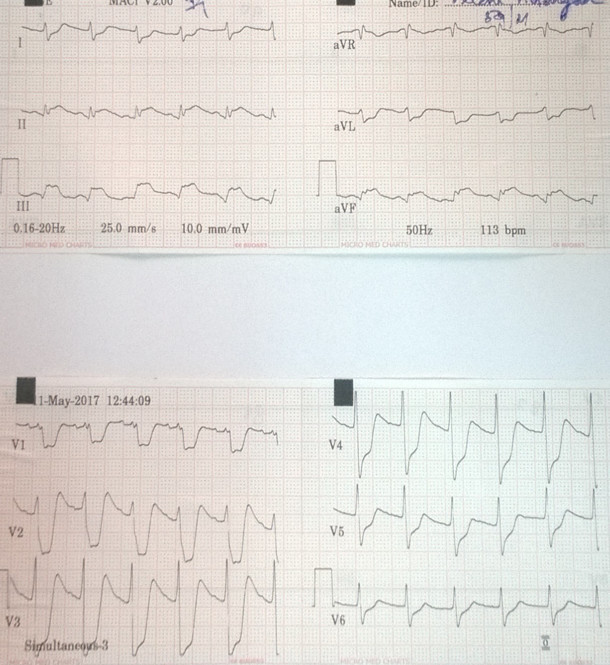 Cardiology window: Acute posterior wall myocardial infarction with ...