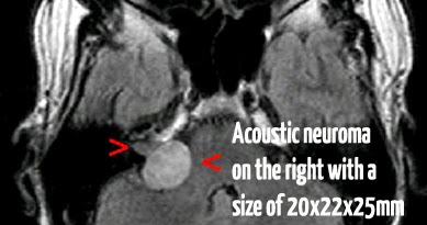 Acoustic Neuroma Explained – Symptoms, Treatments and Surgery
