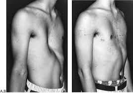 Medical Treatment Pictures-for Better Understanding: Pneumonectomy ...