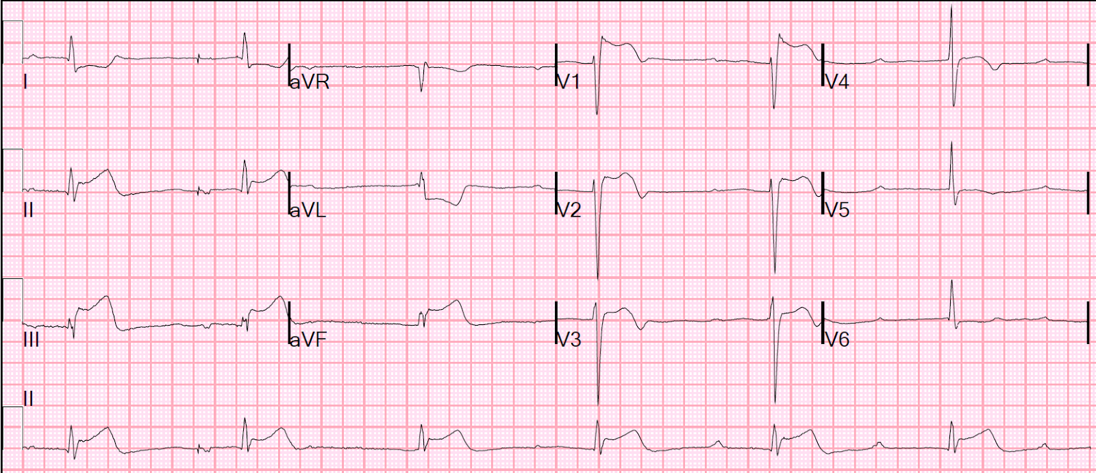 Dr. Smith's ECG Blog: Acute chest pain, bradycardia, and hypotension
