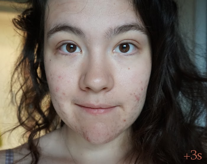 At War with Acne: Cicalfate & TriAcnéal Expert (Avène) won ! - Flavour ...