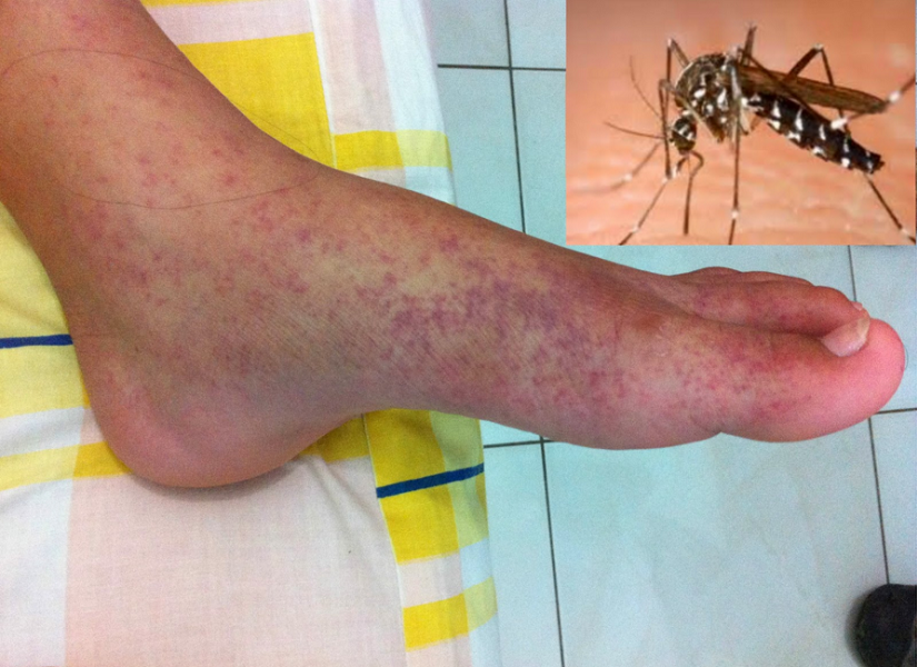 Penyakit Chikungunya Ditularkan Oleh - Perumperindo.co.id