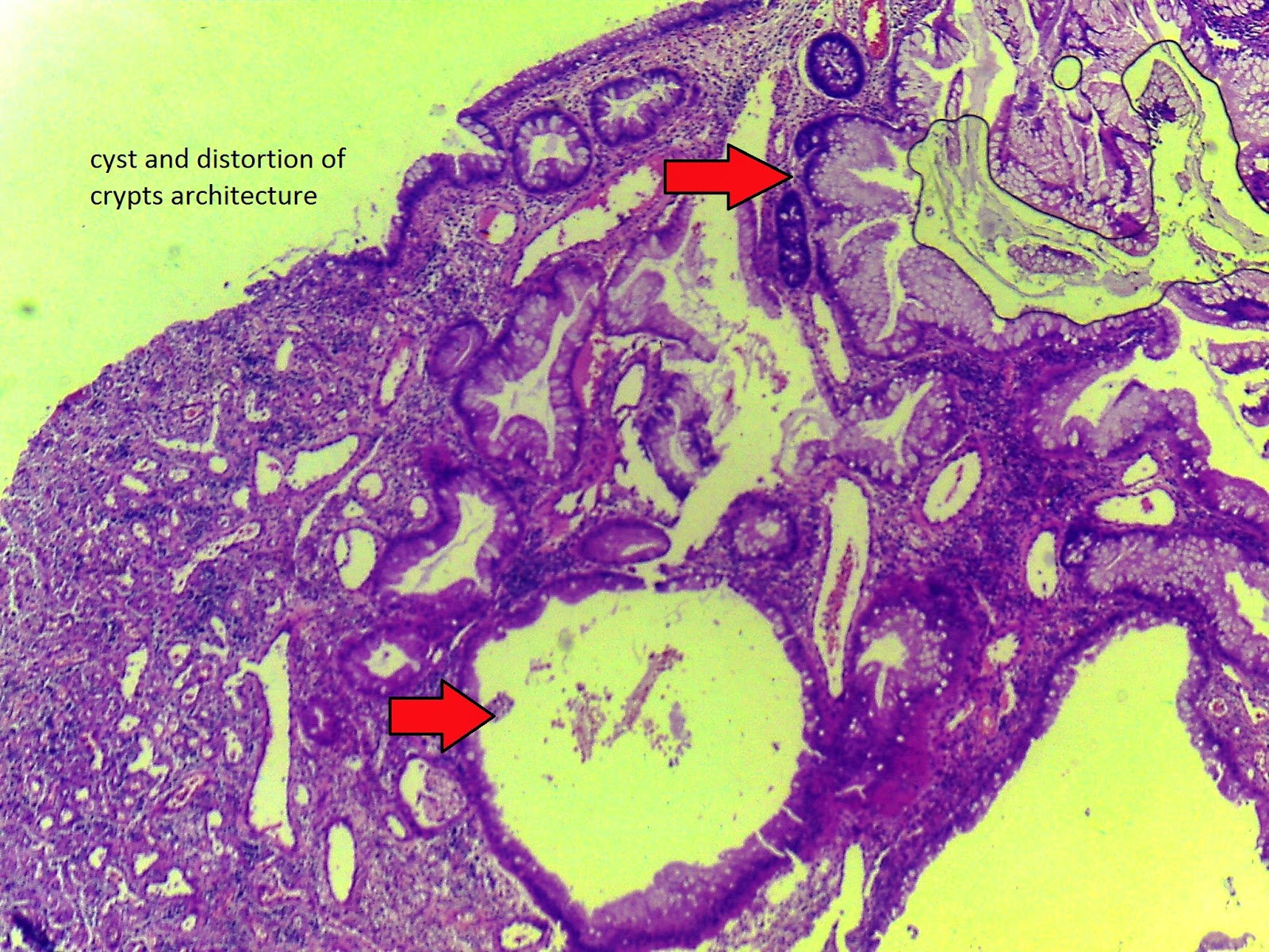 GASTROINTESTINAL AND LIVER HISTOLOGY PATHOLOGY ATLAS: COLON: JUVENILE POLYP