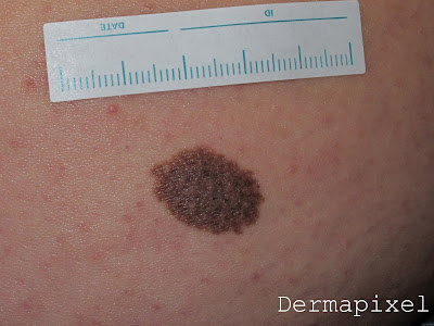 Dermapixel: abril 2013