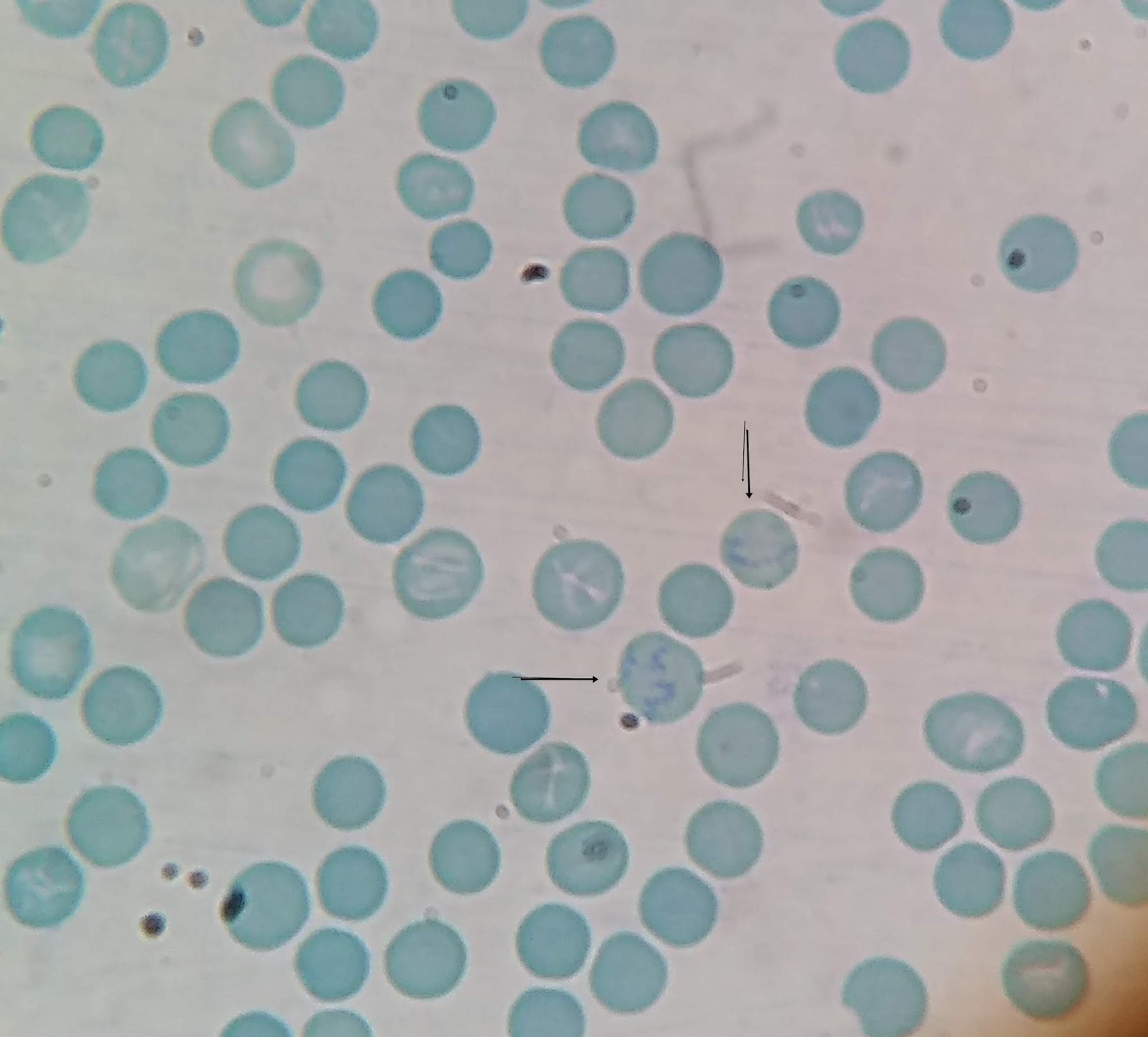 Contagem de Reticulócitos