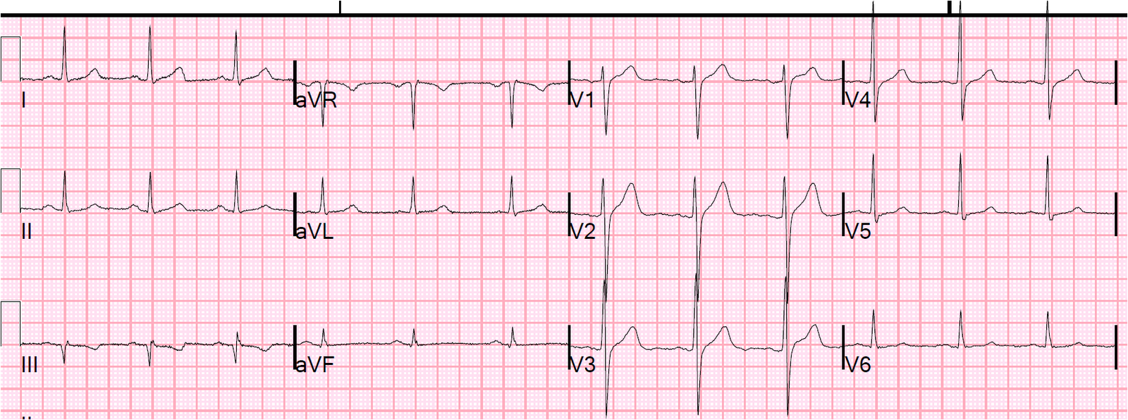 Dr. Smith's ECG Blog: Inferior Dynamic T-waves