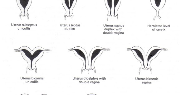 Endoscopia Ginecologica: Complete septate uterus with cervical ...