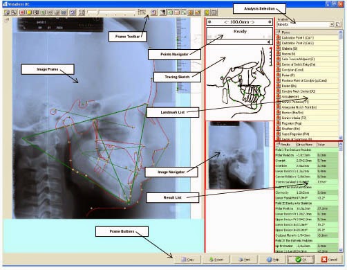 Analisa Sefalometri Digital: Program Analisa Sefalometri