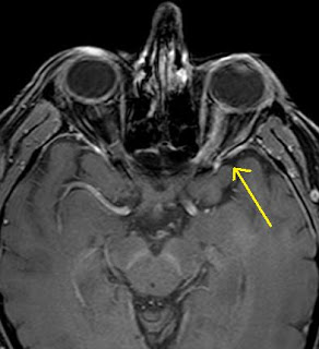 MRI Differential Diagnosis: Optic nerve enhancement