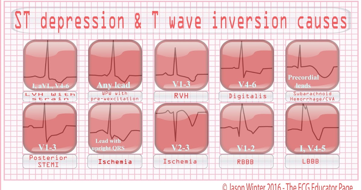 ECG Educator Blog : ST depression & T wave inversion causes