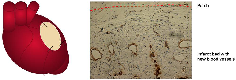 Columbia Engineers Patch A Heart | NextBigFuture.com