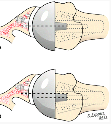 UW Shoulder and Elbow Academy: Glenoid retroversion, "correction" and ...