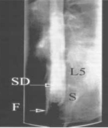 Por los caminos de la osteopatía: LA FORCE DE TRACTION MÉDULLAIRE
