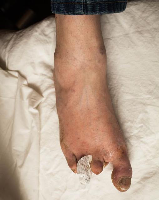Man cuts off his own toes with pliers after hospital cancelled his ...