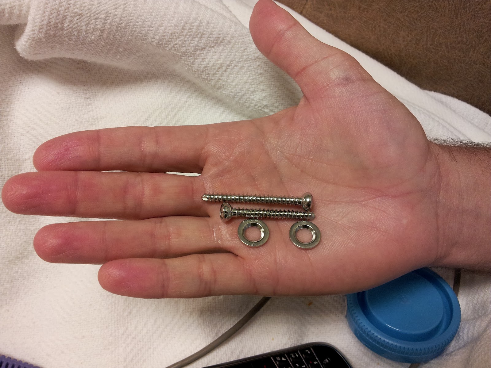 Jim's Bionic Knee: Hardware removal