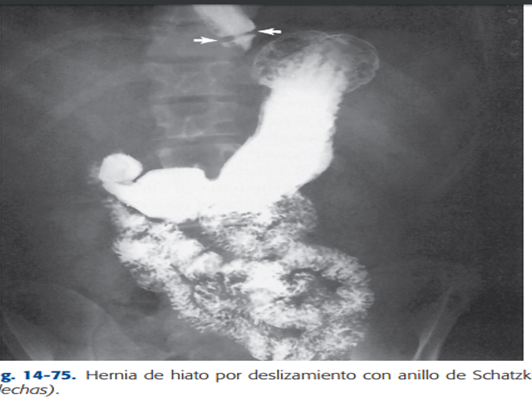 Estudios Contrastados del Sistema Digestivo: Tránsito Esofagogastroduodenal