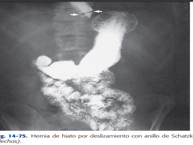 Estudios Contrastados del Sistema Digestivo: Tránsito Esofagogastroduodenal