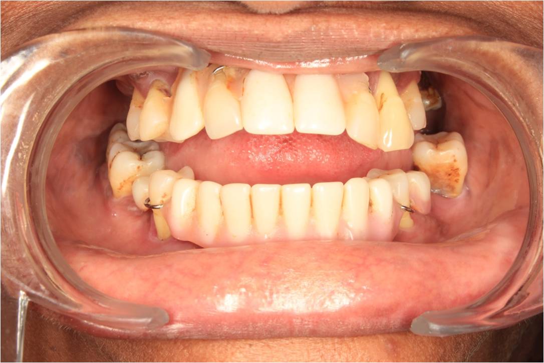 Best dental clinic chennai: FULL MOUTH REHABILITATION WITH BASAL ...