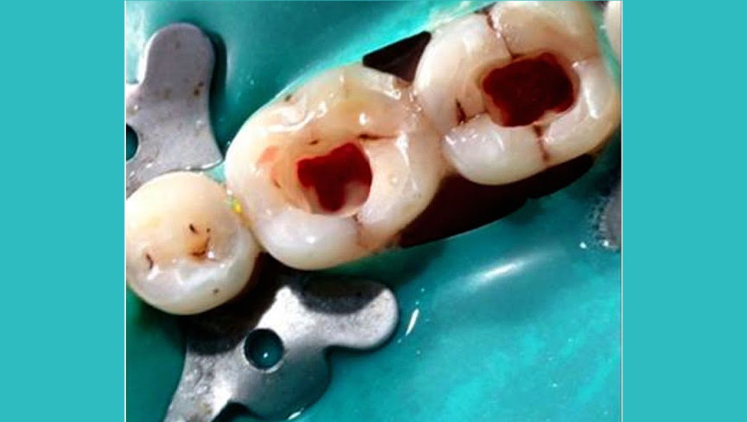 ODONTOPEDIATRÍA : Pulpotomía y pulpectomía (Tratamiento de Nervio ...