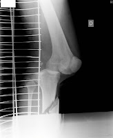 Salud Osteoarticular: LUXACION DE RODILLA