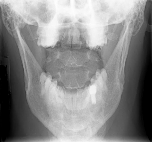 Dens Fracture Treatment | Dens Bone Fracture Surgery